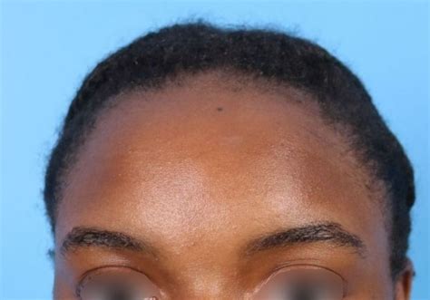 Forehead Reduction Before After Raleigh NC North Raleigh Plastic Surgery