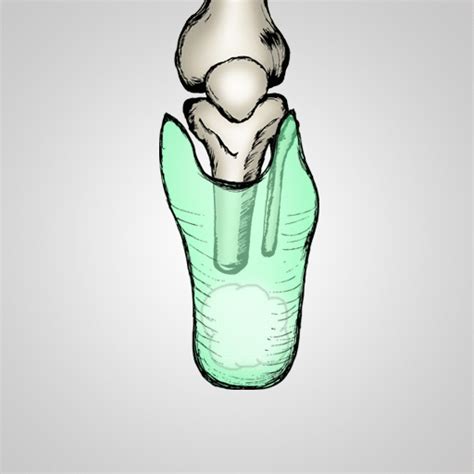 Total Surface Bearing Transtibial Socket Finder