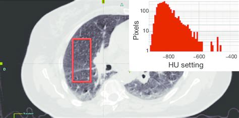 Computed Tomography CT Slice From One Patient Illustrating The Pixel Download Scientific