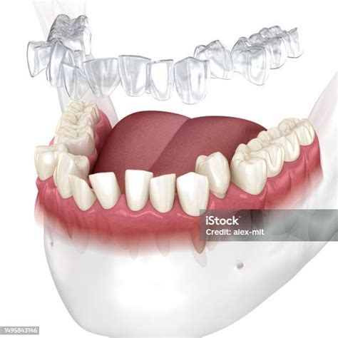중괄호 또는 보이지 않는 리테이너 의학적으로 정확한 치과 3d 일러스트레이션 정직에 대한 스톡 사진 및 기타 이미지 정직 이빨 치아 교정장치 Istock