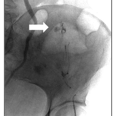 Arteriography And Angioembolization Of Previous Exampled Patients A Download Scientific