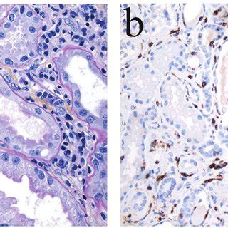 PDF Diffuse Infiltrative Lymphocytosis Syndrome A Case With Multiple Extra Glandular