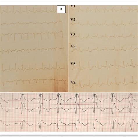 A ECG Showing ST Segment Elevation In V1 AVR And DIII Leads Download Scientific Diagram