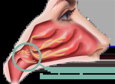 Neuromark® Procedure For Chronic Rhinitis In Louisville Ky And Jeffersonville In