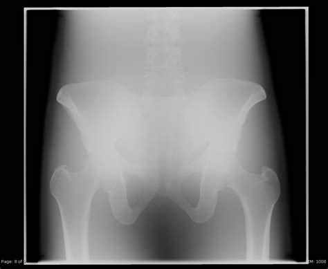 Scatter Removal Grids Radiology Suny Upstate