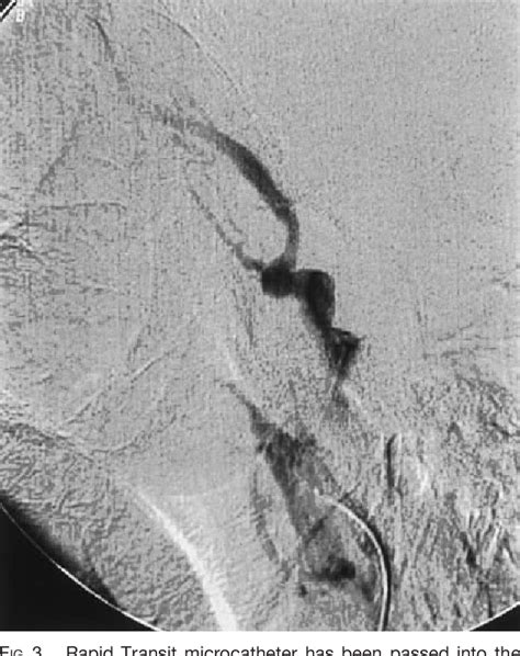 Figure 1 From Pterygoid Plexus Carotid Cavernous Fistula Through The Transvenous Embolization Of