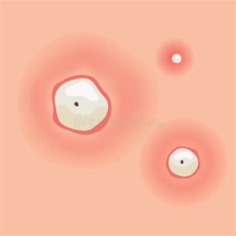 Understanding Type Of Acne A Comprehensive Visual Guide For Everyone Stock Illustration