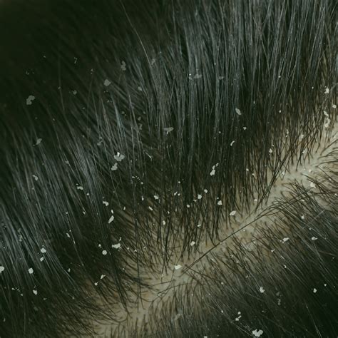 What Is Dandruff Causes Symptoms And Misconceptions Psodex
