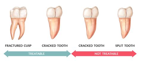 Is A Cracked Tooth Treatable Root Canal Treatment Crown Twinkle