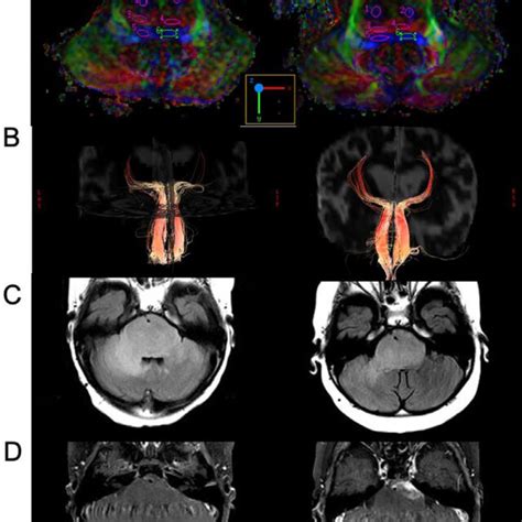 a diffusion tensor imaging color fractional anisotropy maps and