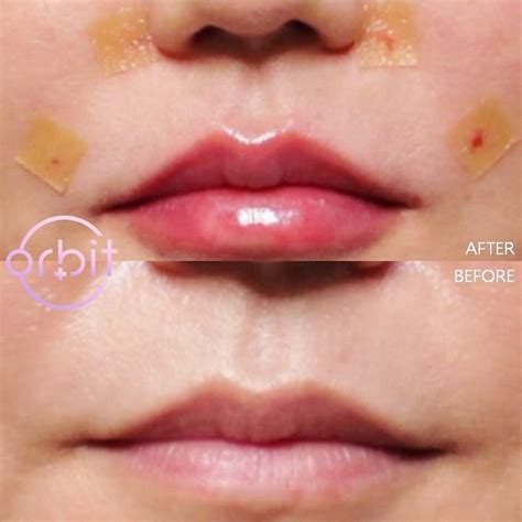 오빗클리닉 ️오빗은 전후사진 보정을 하지 않습니다 ️내돈내산 후기☺️💋💖 필러맛집💋