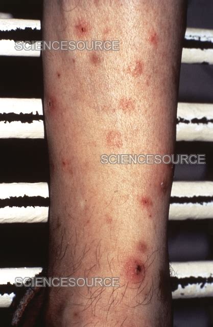 Lymphoid Leukemia Bruising Stock Image Science Source Images
