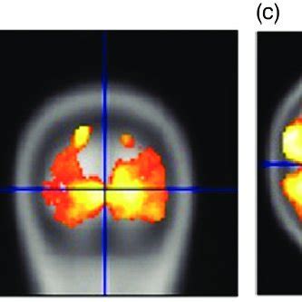 Usual Activation Of The Visual Cortex In Control Subject No 4 Download Scientific Diagram