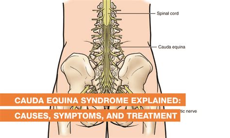 Cauda Equina Syndrome Symptoms Causes And Emergency Treatment