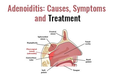 Adenoiditis Causes Symptoms And Treatment Vkare