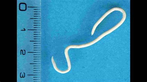 Toxocara Toxocariasis Caused By Toxocara Canis Or Cati Symptoms Diagnosis Treatment Youtube