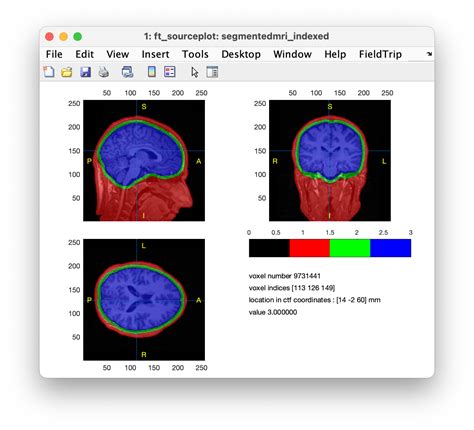 Creating A Bem Volume Conduction Model Of The Head For Source Reconstruction Of Eeg Data