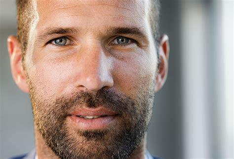 Fractured Orbital Bone