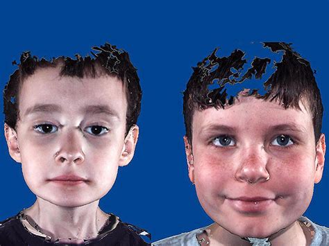 Is It Autism Facial Features That Show Disorder Artofit