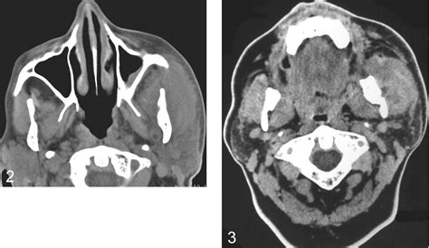 Chronic Submasseteric Abscess Anatomic Radiologic And Pathologic
