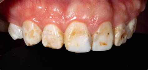 Celiac Disease Brown Spots On Teeth What You Need To Know Mt Kelly Dmd