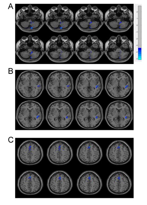 Aberrant Volume Wise And Voxel Wise Concordance Among Dynamic Intrinsic