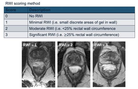 Aua 2023 Real World Assessment Of Mri Predictors Of Rectal