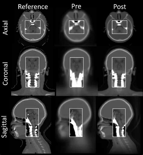 Average Ct Images Treatment Planning Ct Images Shown For The Reference Download Scientific