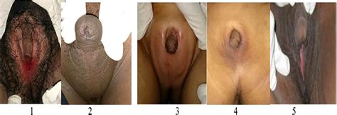 Congenital Adrenal Hyperplasia