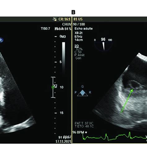 Literature Review Of Infective Endocarditis Caused By Scedosporium Spp