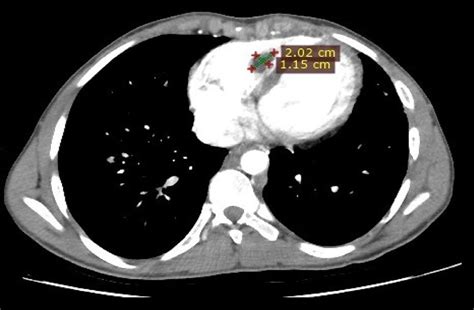 Ct Scan Image Showing A Right Ventricle Thrombus Download Scientific Diagram