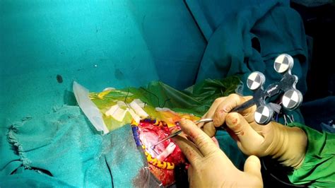 [video] Dr Rajesh Kumar Singh On Linkedin Awake Craniotomy Under Scalp Block He Had A Brain