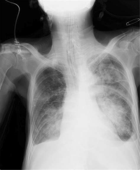 Chest X Ray Depicting Diffuse Bilateral Pulmonary Infiltrates After