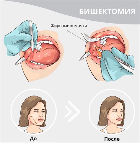 Комки Биша: что это, где находится, зачем нужны, как выглядит, как ...