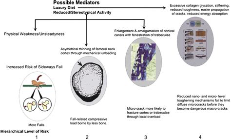 Role Of Cortical Bone In Hip Fracture Pmc