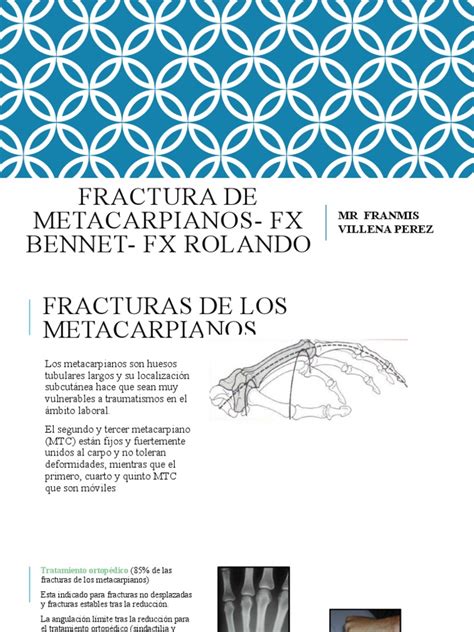 Fractura De Metacarpianos Fx Bennet Fx Rolando Fvp Pdf Ciencia Y Matemáticas