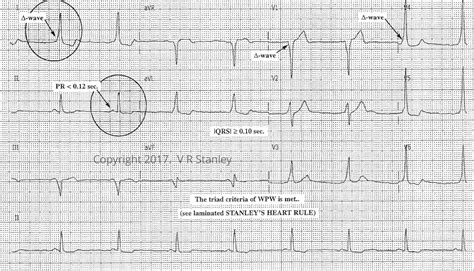 Wolff Parkinson White Syndrome Short Pr Interval