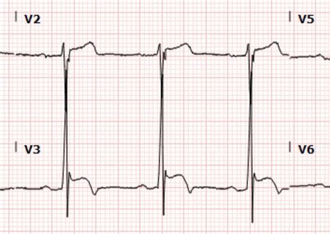 2 Early Repolarization Variants Funky St T Segments To Learn And Save ♥️ Benign Early 2 Early Repolarization Variants Funky St T Segments To Learn And Save ♥️ Benign Early