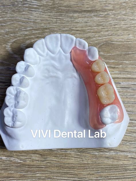 High Esthetics Flexible Acrylic Partial Denture Valplast Dental Partials
