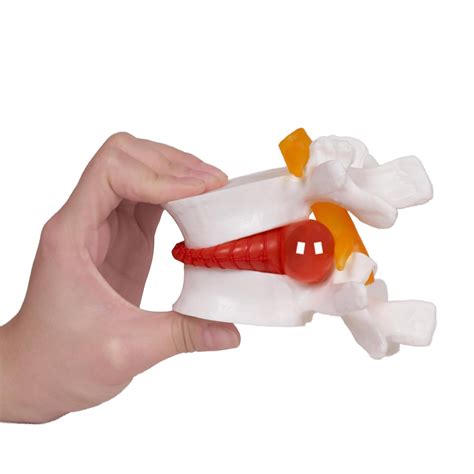 Human Anatomical Lumbar Disc Herniation Model Chile Ubuy