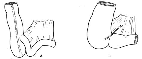 Paper Appendix Vermiformis Duplex Embryology