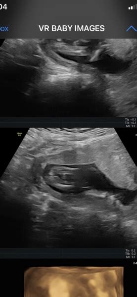 Gender Scan Boy Or Girl 😁 Mumsnet
