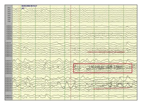 Subdural Intracranial Eeg Ieeg Recorded Frontal Lobe Onset Seizure Download Scientific