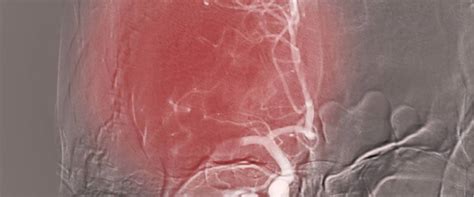 Interventional Radiology The Stroke Patient