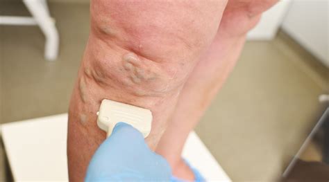 Ceap Classification Of Chronic Venous Disorders