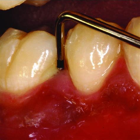 Pdf Management Of Exposed Collagen Membrane After Socket Seal Surgery