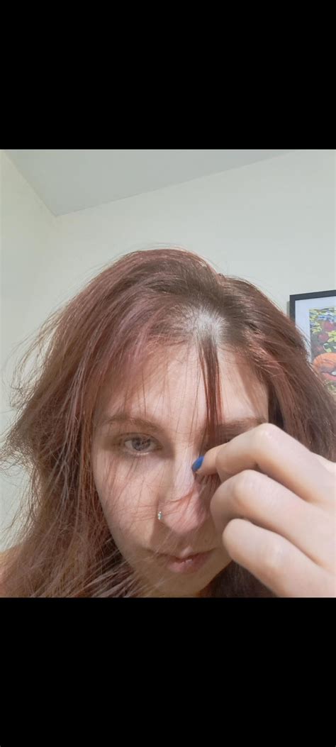 Another Monoxidil Before And After So Happy With How Well And How