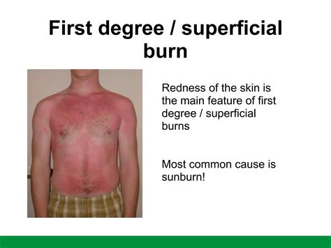 First Aid In Burns Pptx