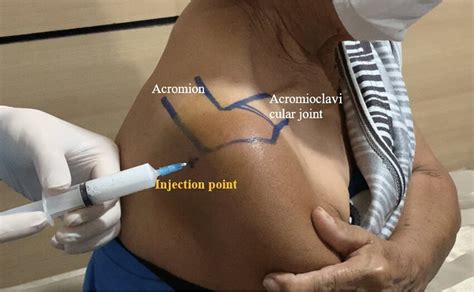 Landmark Of The Posterior Approach Of Subacromial Corticosteroid Download Scientific Diagram