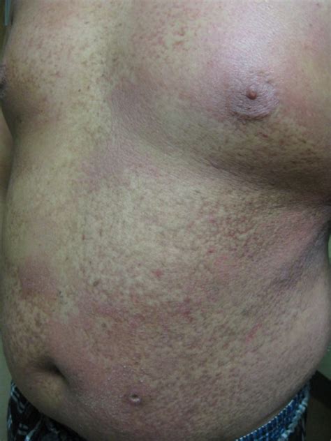 Pruritic Rash Involving Upper Torso And Extremities Dermatology Grand